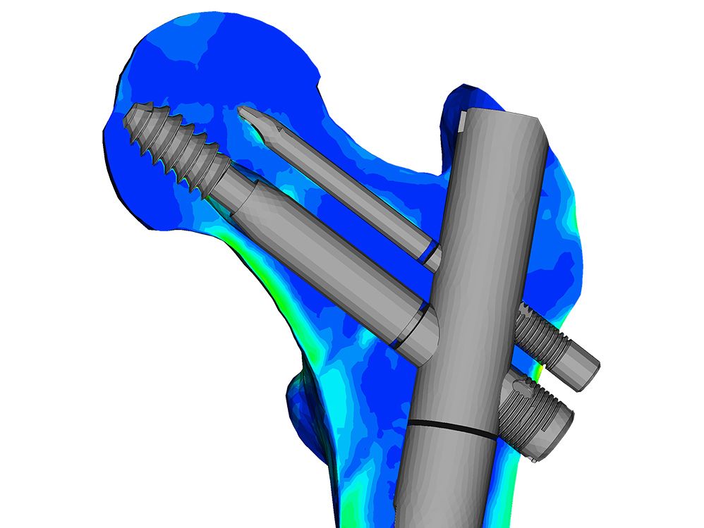 Leg Implant Simulations Keep Medical Field and Patients Moving Forward ...